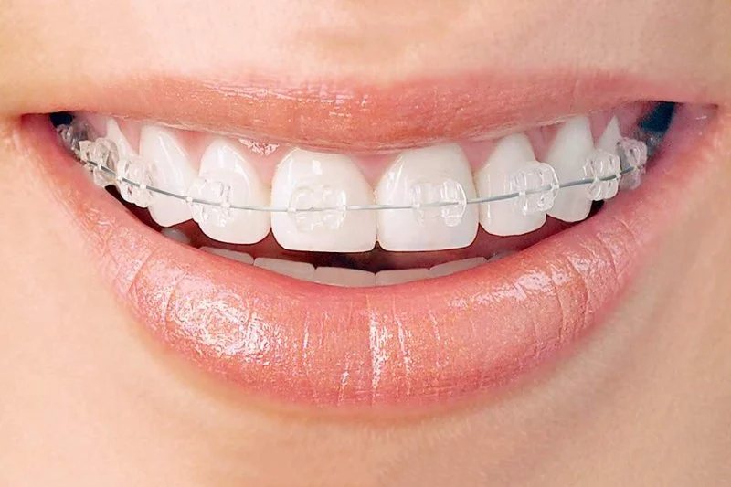 What to Know About Clear Braces (Ceramic Braces) and Their Maintenance